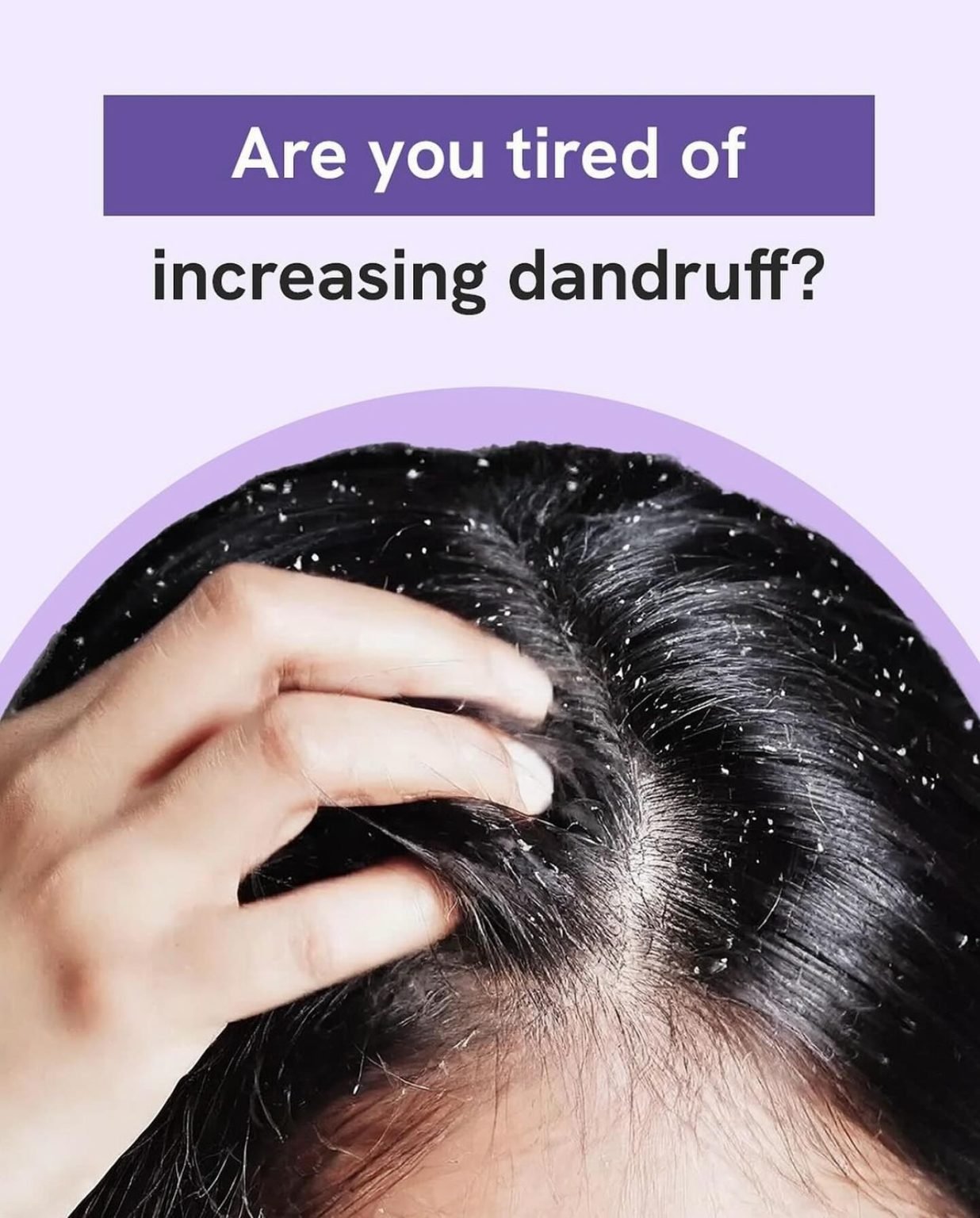 Remedies For Winter Dandruff- 8 Amazing Tips for Flaky Scalp